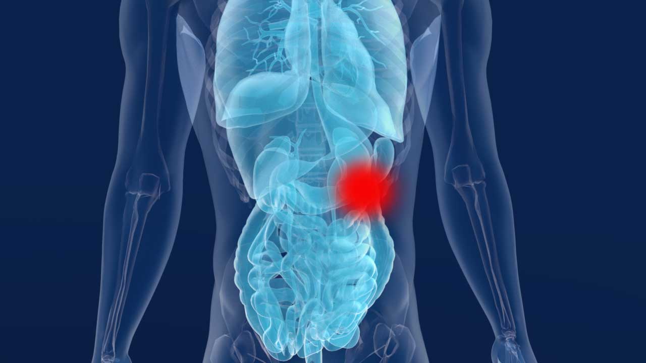 Σάρκωμα | Δρ. Α. Πέτρου